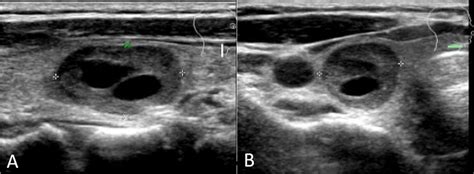 Us Features Of I Mtc A B A Thyroid Nodule With A Round Tumor Shape