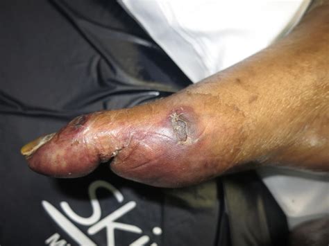 Progressive Diffuse Calciphylaxis With Facial Involvement Despite