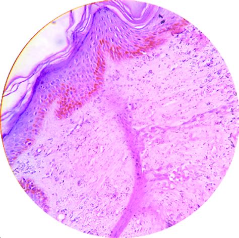 Atrophy Of The Epidermis And Reticular Dermis And Replacement Of The Download Scientific