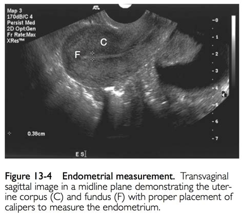 Uterine Ultrasound Imaging