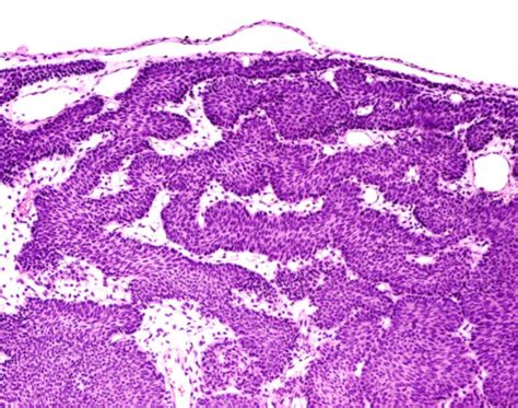 Flat Urothelial Hyperplasia Download Scientific Diagram