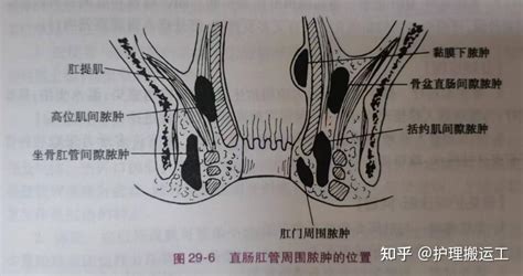 直肠肛管周围脓肿 知乎