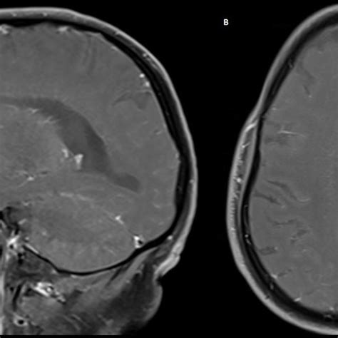 A Sagittal Post Contrast T1 Mri Of The Brain After 1 Month Of Illness
