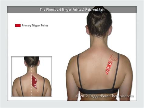 Rhomboid Trigger Points A Pain Between The Shoulder Blades TriggerPointTherapist Com