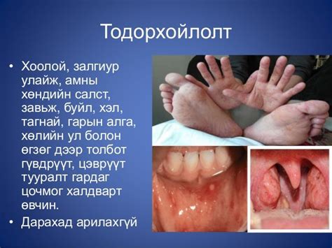 гар хөл амны өвчин