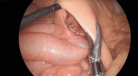 Laparoscopic Right Hemicolectomy Jandj Medtech Us