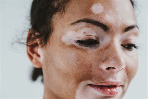 How Vitiligo Is Treated