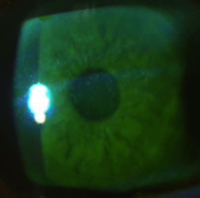Sicca Keratopathy Of The Right Eye Seen As Superficial Punctate