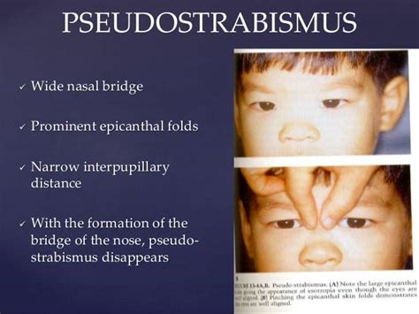 Congenital Infantile Esotropia