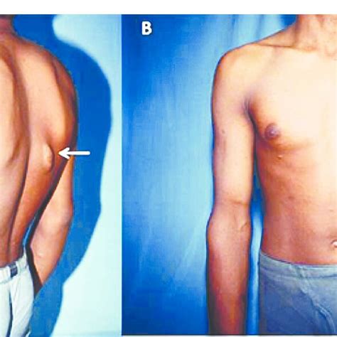 Figure Patient Of Plexiform Neurofibromatosis Presenting With Multiple