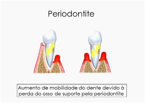 PERIODONTIA Dentes Moles Uma História Dramática de Periodontite