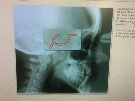 Ortho Midterm Flashcards Quizlet
