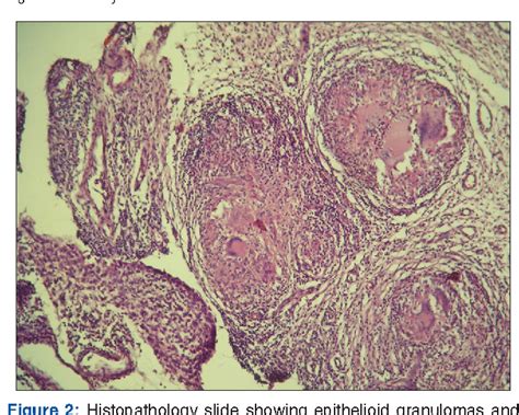 Figure 1 From Use Of Amplified Mycobacterium Tuberculosis Direct Test
