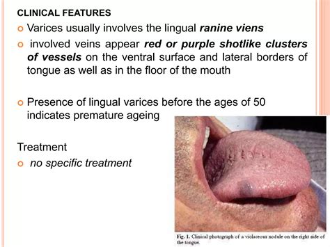 Developmental Disturbances Of Tongue Pptx