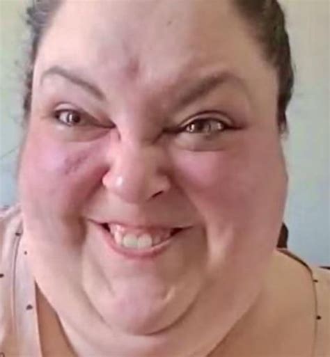 Malformation Monday Rat Face R Foodiecutie