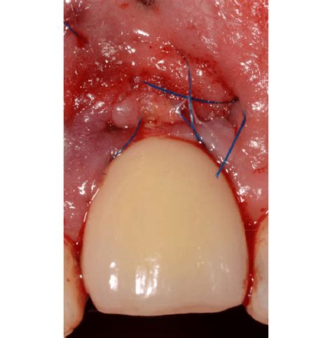The Subepithelial Connective Tissue Graft Has Been Inserted Into The