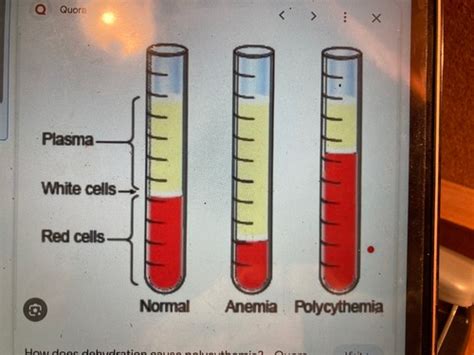 Anemia Flashcards Quizlet