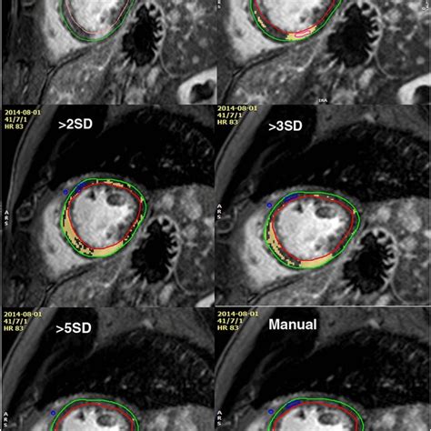 Example Of Endocardial And Epicardial Segmentation Of The Myocardium In Download Scientific