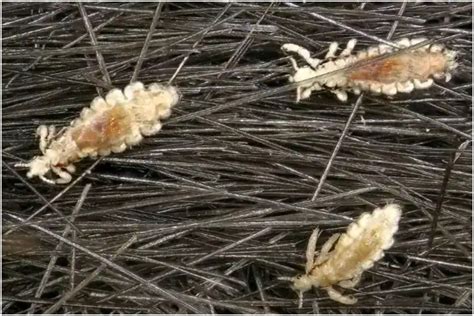 Lice In Rainy Season बारिश के मौसम में बच्चों के सिर में पड़ गए हैं