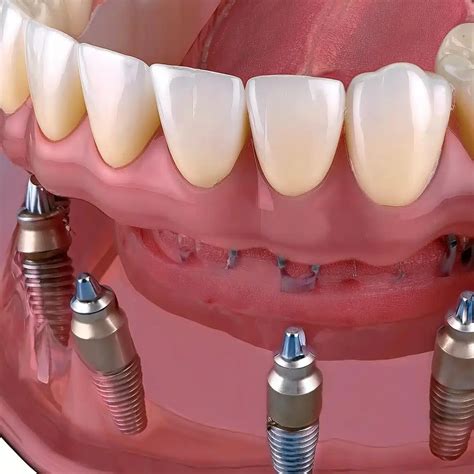 All On 4 Dental Implants Immediate Loading