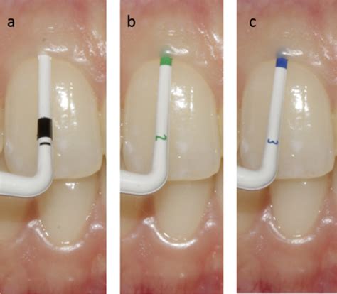 Assessment Of Gingival Phenotype Using A White B Green And C Blue