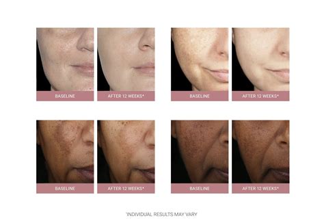 What Is Thiamidol And How Does It Work