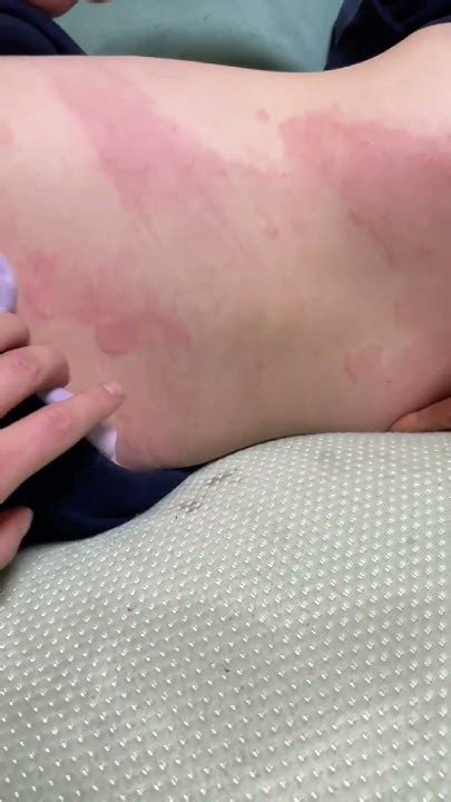 她很痒，她自己抓不到，她也不会说话表示寻麻疹的痛苦寻麻疹天使综合症希希 Youtube
