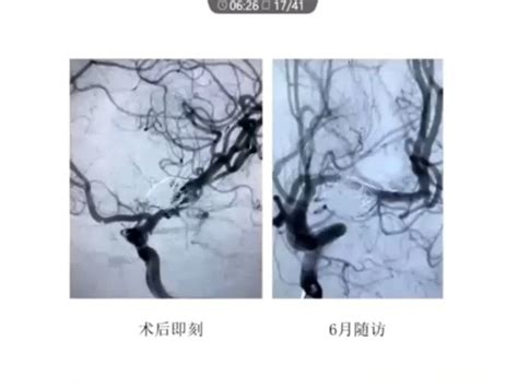 李侠教授：复杂动脉瘤介入治疗 脑医汇