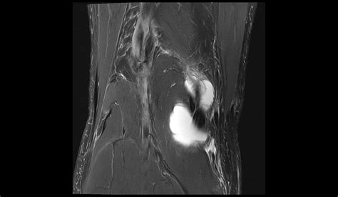 Bakers Cyst Rupture Mri Radiology Article On Baker Cyst Rupture