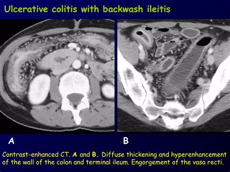 Ulcerative Colitis Ppt