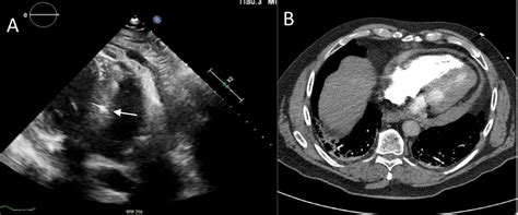 A Transthoracic Echocardiogram Showing Lp In Septal Position Arrow