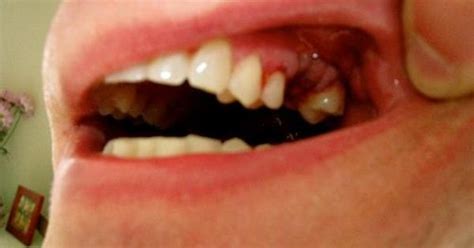 Figure Alveolar Osteitis Dry Socket After Mandibular