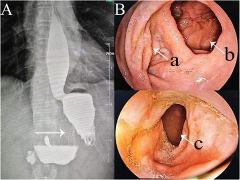 Frontiers Case Report Surgery For Proximal Gastric Cancer With