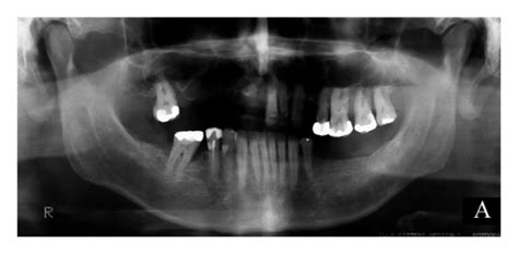 Panoramic Radiographs Of The Patient A Taken At The First Visit No