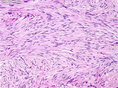 GIST In NF1