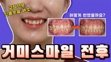 잇몸웃음 수술없이 교정으로 치료하자👍🏻 [거미스마일 교정전후] Youtube