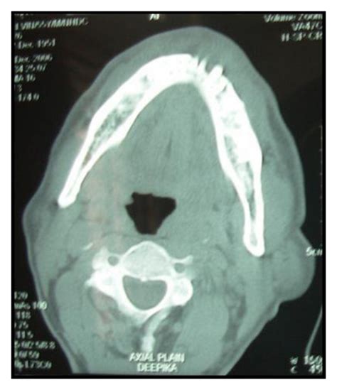 Erosion Of The Anterior Cortex Of The Left Body Of Mandible Seen On The