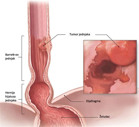 Z Line Esophagus Phrenoesophageal Ligament