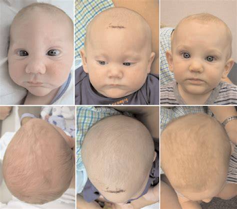 Figure 1 From Endoscopic Assisted Repair Of Craniosynostosis
