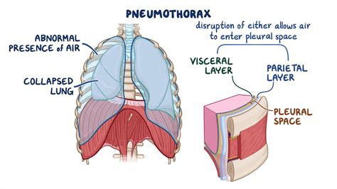 Open Pneumothorax What Is It Diagnosis And More Osmosis Off