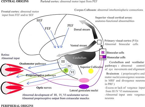 Origins Of Strabismus And Loss Of Binocular Vision In 2025 Vision