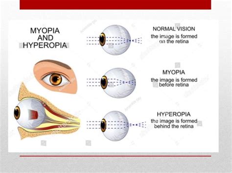 Hypermetropia Ppt