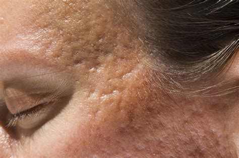 Are Acne Scars Permanent