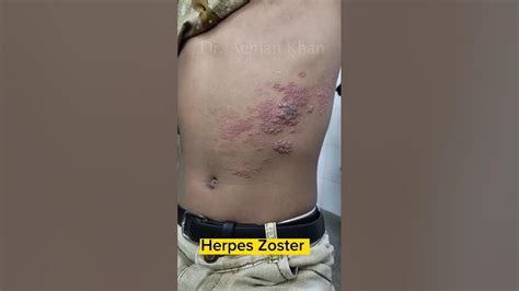 Herpes Zoster Shingles 👆🏻🔥🤯 Note Dermatomal Pattern Doctor Chickenpox Youtube