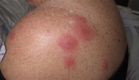 Acute Febrile Neutrophilic Dermatosis Sweet Syndrome Gomm Button
