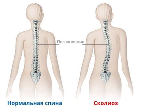 Сколиозы