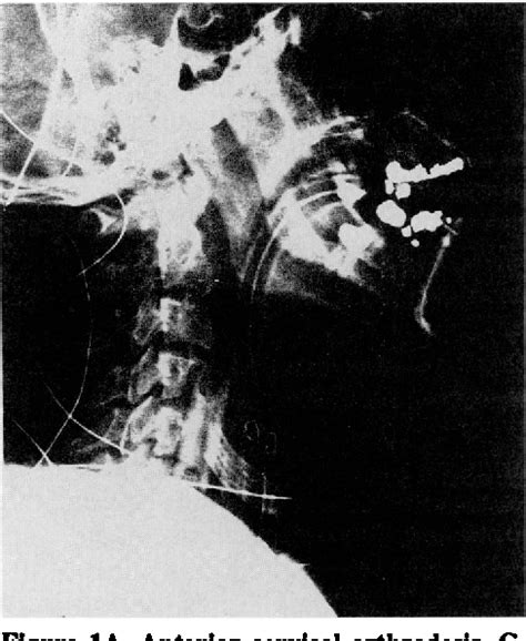 Freeze Dried Fibular Allograft In Anterior Spinal Surgery Cervical And