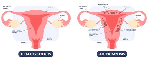 Boggy Uterus What Is It Causes Treatment And More 43 Off