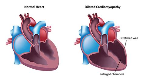 Dilated Cardiomyopathy Symptoms Causes And Risk Factors Diagnosis