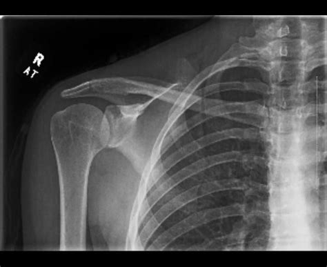 30yr Female Type Ii Acromion Heds R Radiology